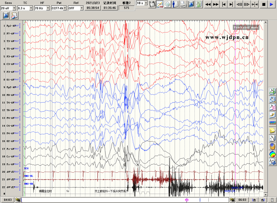 癫痫伴肌阵挛-失张力发作（Doose 综合征） - 儿童癫痫长程管理