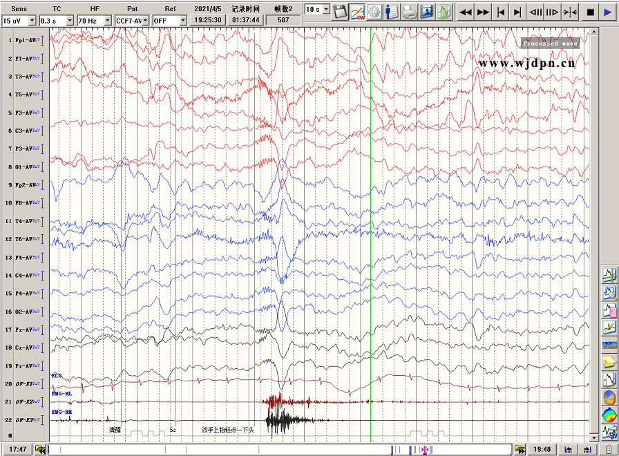 Infantile Epileptic Spasms Syndrome - Long-term Management Of Children ...