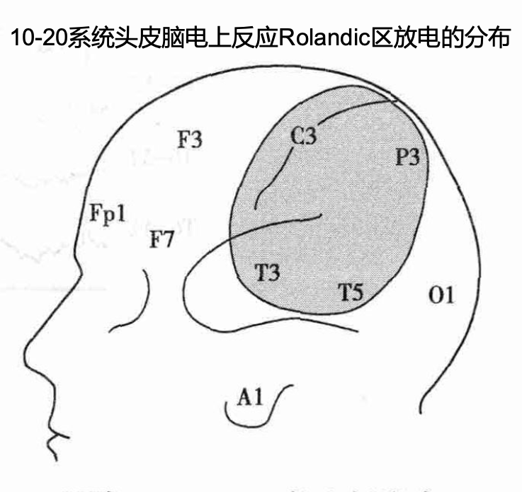 Self-limited epilepsy with centrotemporal spikes - Long-term Management ...