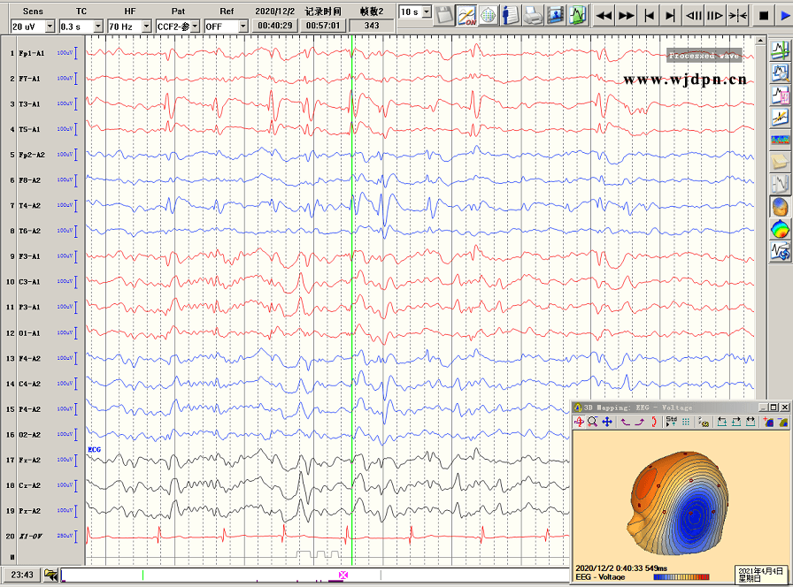 伴中央颞区棘波的自限性癫痫（原先习惯叫BECT） - 儿童癫痫长程管理
